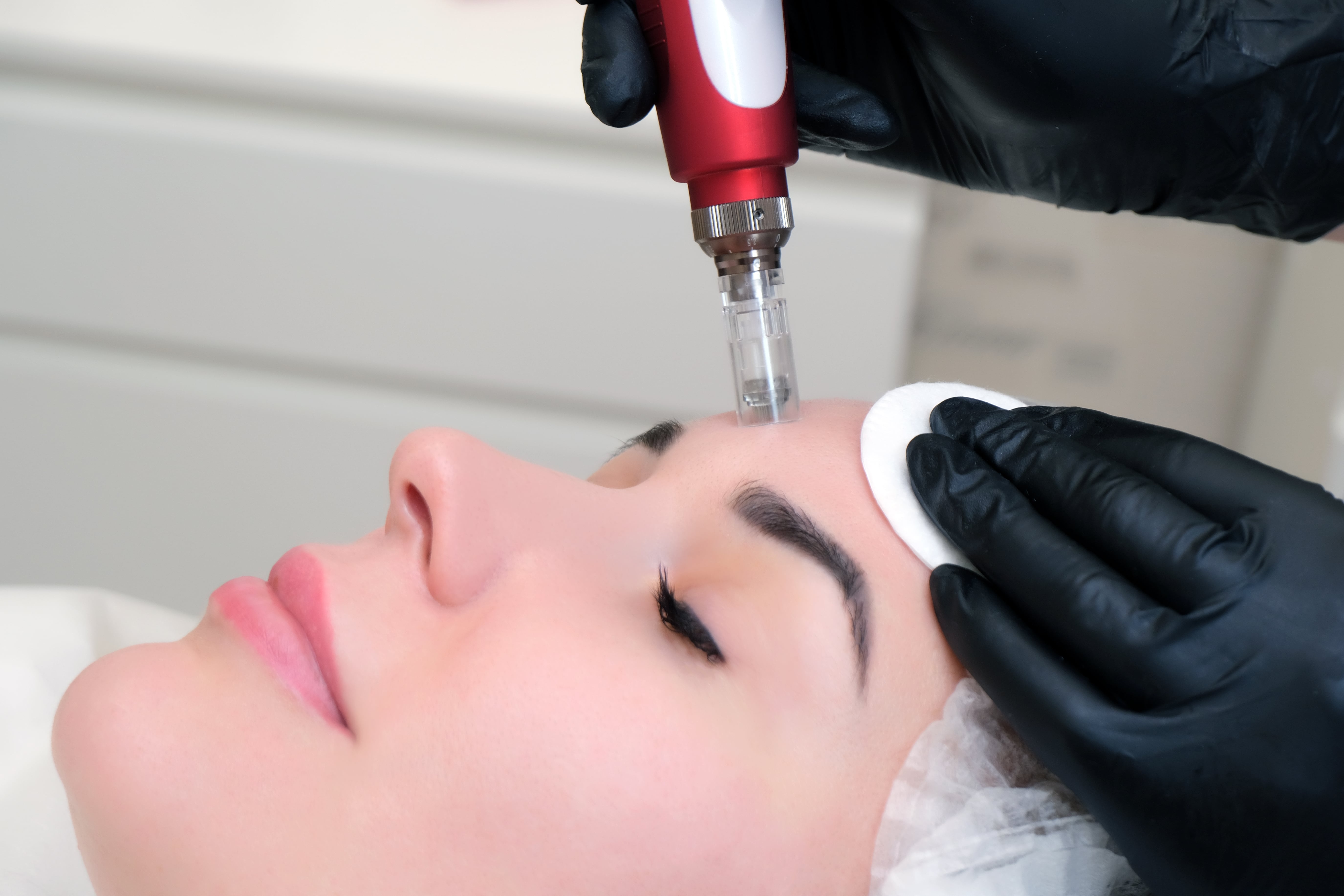 Microneedling | EastsidegentleAcupuncture