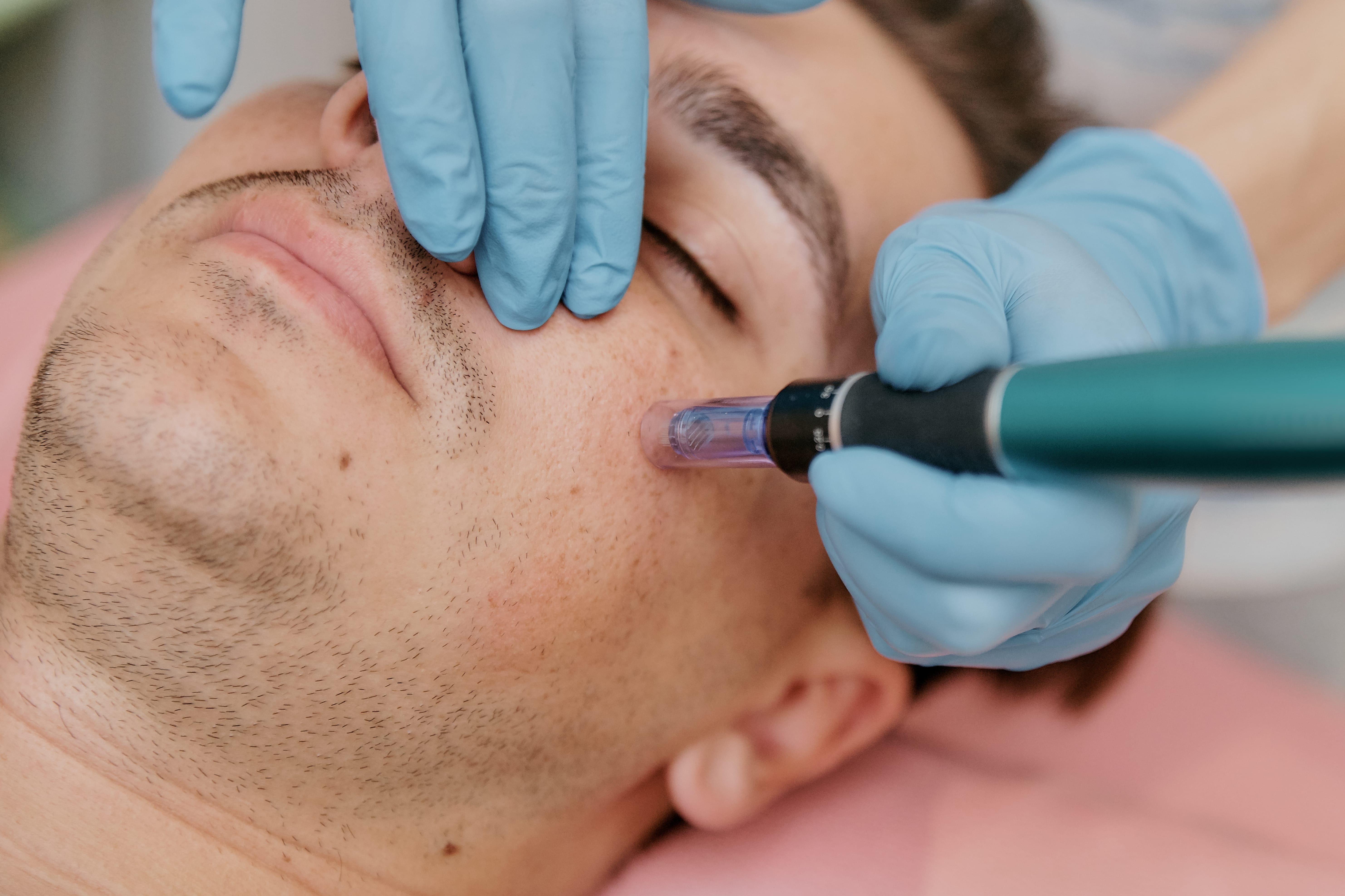 Microneedling | EastsidegentleAcupuncture